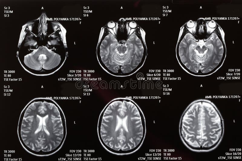 Heart beat on ECG screen stock illustration. Illustration of life - 6513001