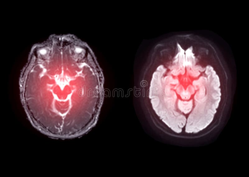 MRI Brain Axial Diffusion Image for Detect Stroke Disease . Stock ...