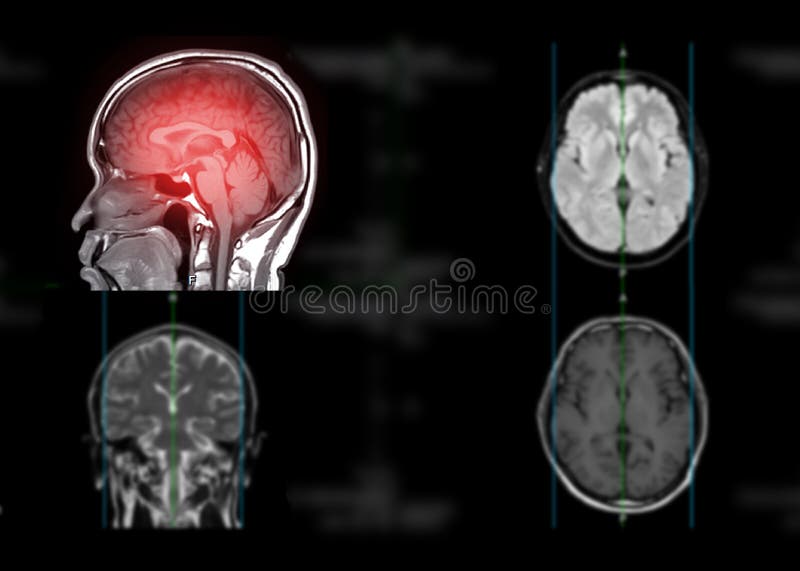 MRI Brain Axial T1W Plane . Stock Illustration - Illustration of ... MRI Brain Axial T1W Plane . Stock Illustration - Illustration of ...