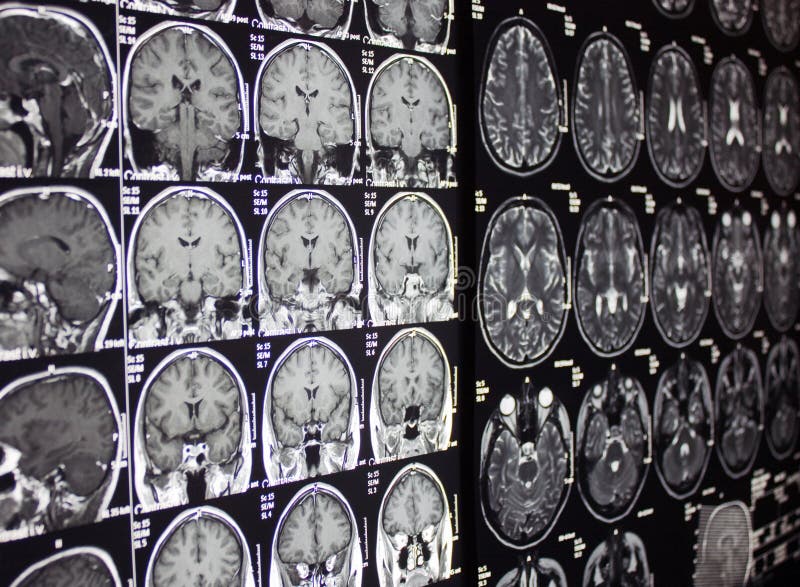 MRI Brain Scan stock photo. Image of intelligence, neural - 28673236