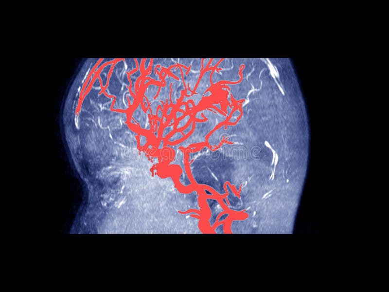 MRI of the BRAIN and MRA & MRV of the BRAIN Stock Image - Image of ... MRI of the BRAIN and MRA & MRV of the BRAIN Stock Image - Image of ...