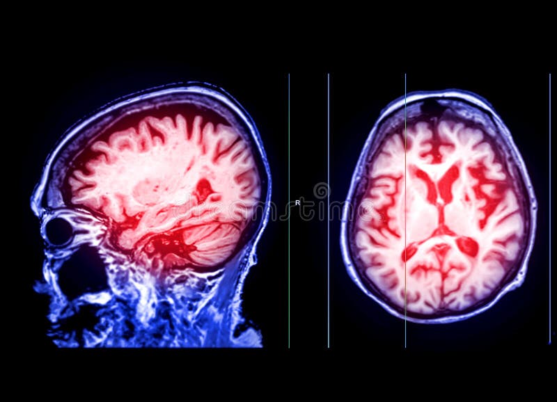 Mri Brain Sagittal And Axial T2 Flair Technique Stock Illustration