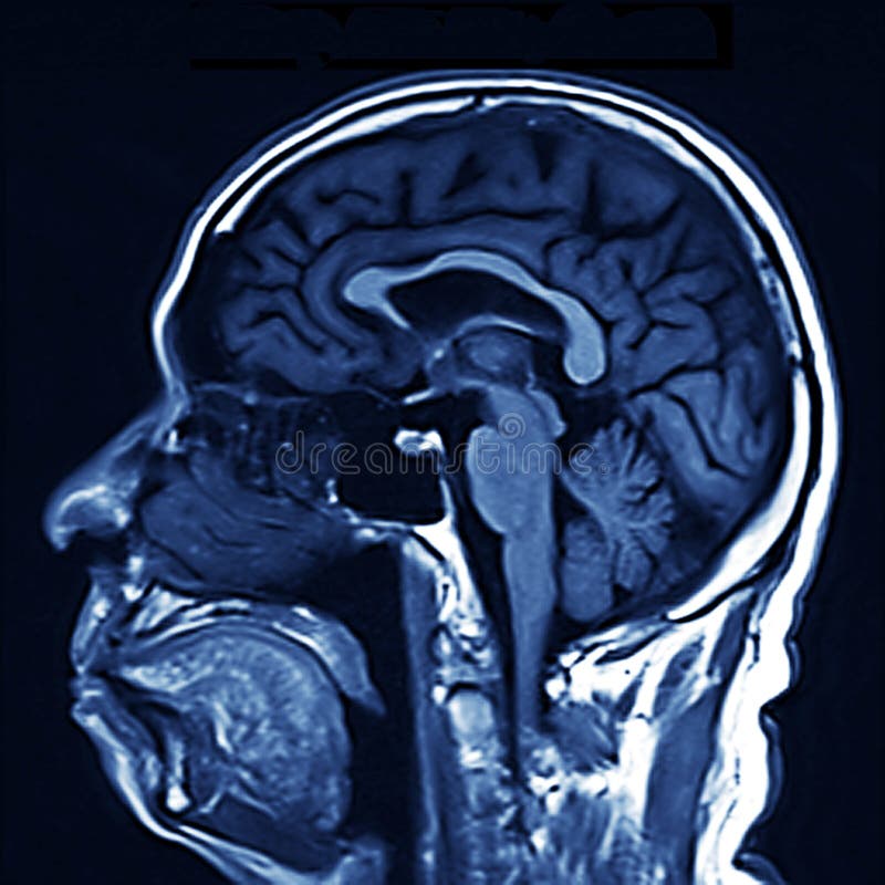 MRI Brain Scan stock photo. Image of callosum, examination - 24527856