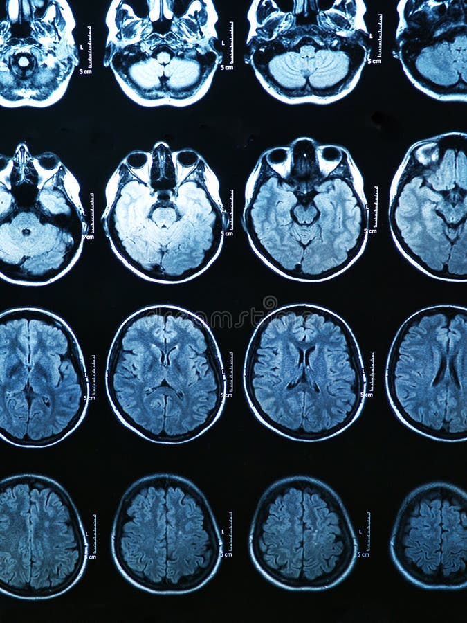 MRI Brain Scan stock photo. Image of intelligence, neural - 28673236