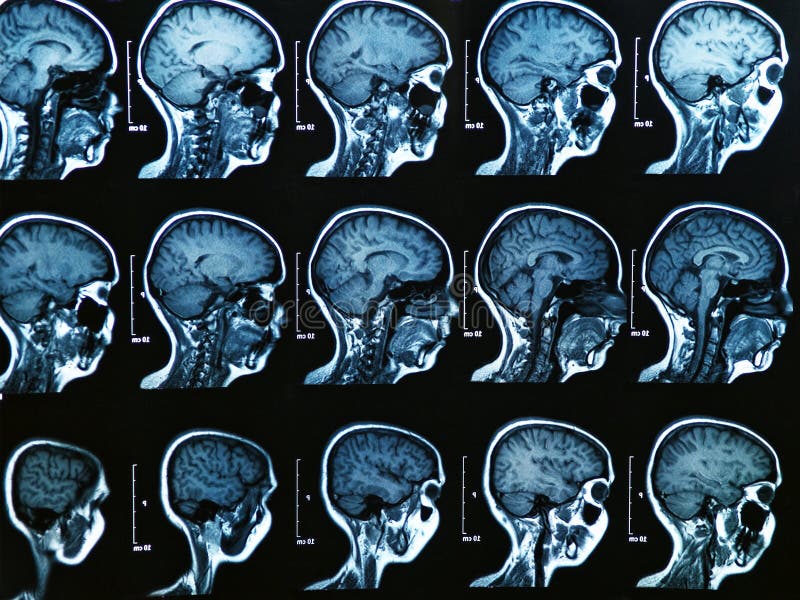Mri Brain Scan stock image. Image of corpus, huntington - 31871707