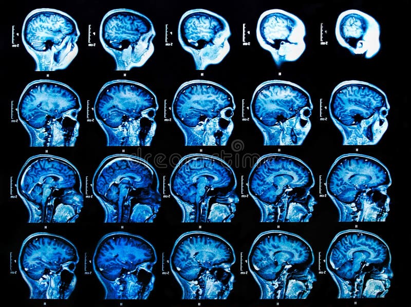 MRI Brain stock photo. Image of medical, magnetic, scan - 2173238