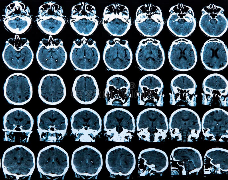 MRI Brain Scan stock photo. Image of healthcare, callosum - 28673536