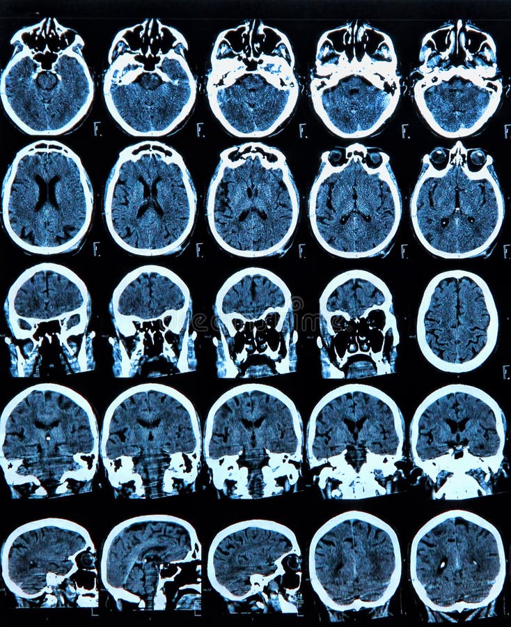 Mri Brain Scan stock image. Image of brain, lobe, hemisphere - 47204981