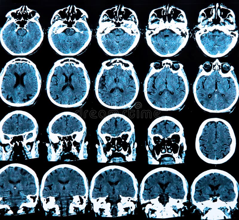 Mri Brain Scan stock image. Image of diagnosis, medical - 49730997