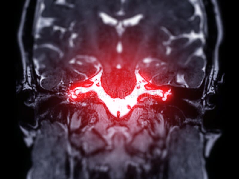 MRI Brain Scan Sagittal and Coronal View with Reference Line for Detect ...