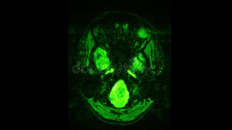 MRI Brain Scan, Magnetic Resonance Image. CT Scan of Human Brain in ...