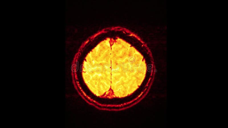Mri Brain Scan Magnetic Resonance Image Ct Scan Of Human Brain In Dynamic Stock Footage
