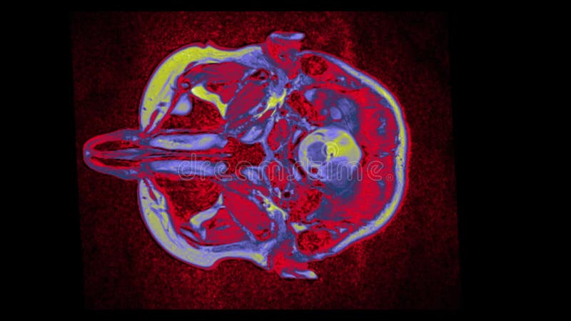 Mri Brain Scan Magnetic Resonance Image Ct Scan Of Human Brain In