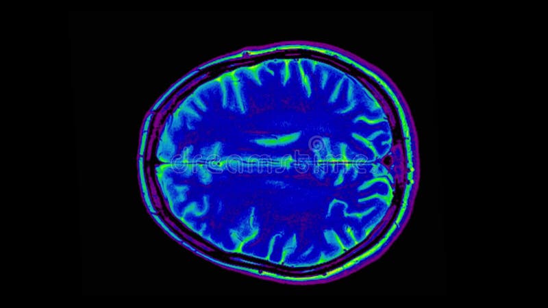 Mri Brain Scan Magnetic Resonance Image Ct Scan Of Human Brain In