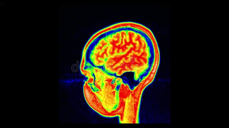 Mri Brain Scan Magnetic Resonance Image Ct Scan Of Human Brain In