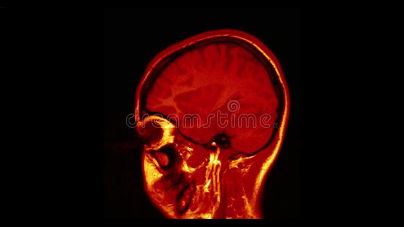 Mri Brain Scan Magnetic Resonance Image Ct Scan Of Human Brain In Dynamic Stock Footage