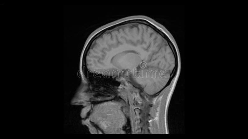 Mri Brain Scan Magnetic Resonance Image Ct Scan Of Human Brain In