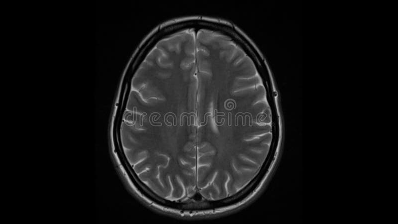 Mri Brain Scan Magnetic Resonance Image Ct Scan Of Human Brain In Dynamic Stock Video Video
