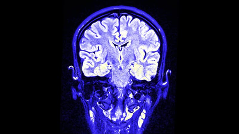 Human MRI Brain Scan on Black Background. Computed Tomography of the ...