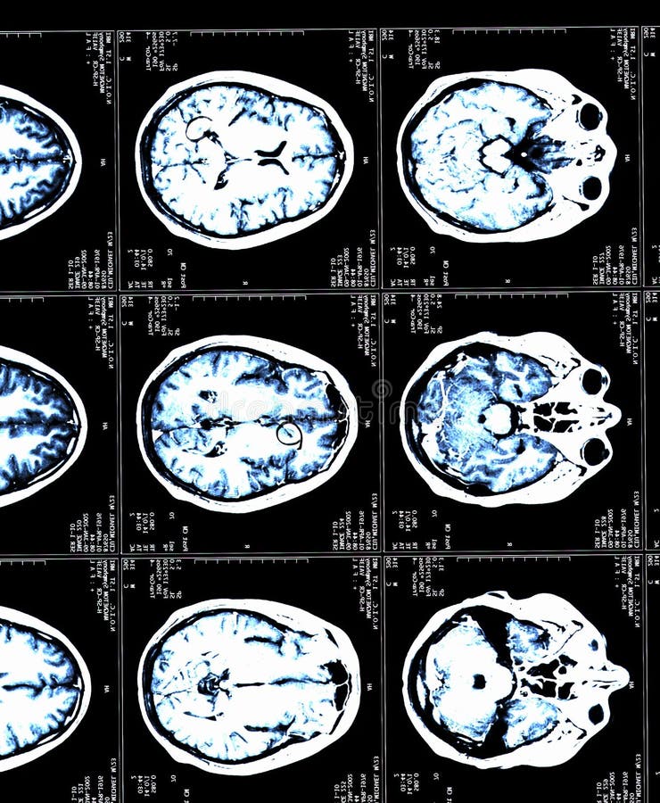 MRI Brain Scans of a Patient with Multiple Sclerosis Stock Photo ...