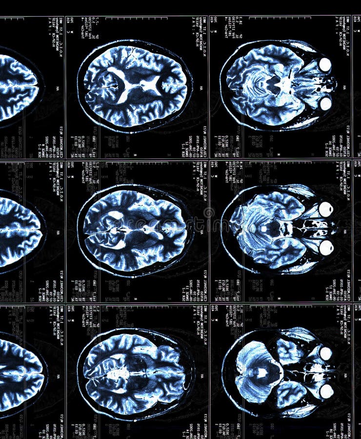 MRI Brain Scans of a Patient with Multiple Sclerosis Stock Image ...