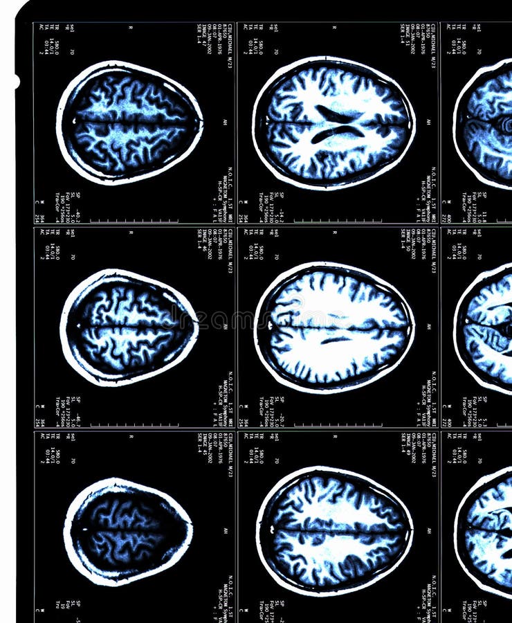 MRI Brain Scans of a Patient with Multiple Sclerosis Stock Image ...