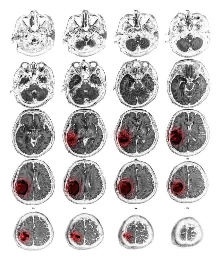 Film MRI ( Magnetic Resonance Imaging ) of Brain ( Stroke , Brain Tumor ...