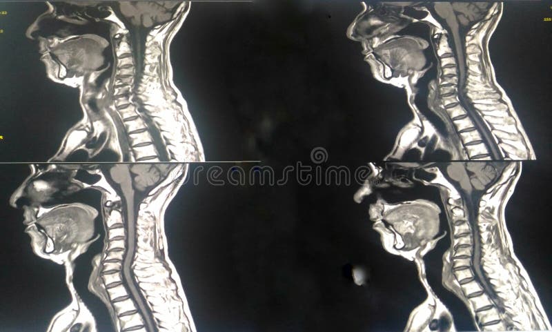 MRT C-ryggrad Eller Magnetisk Resonansbild Av Cervikal Ryggrad ...