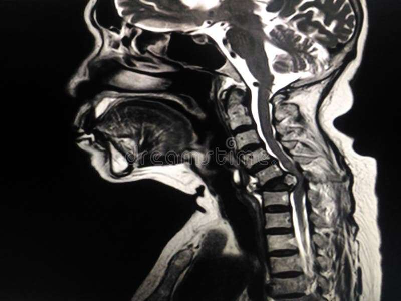 X-ray Image and MRI of Cervical Spine Case Trauma Showing C4,5 ...