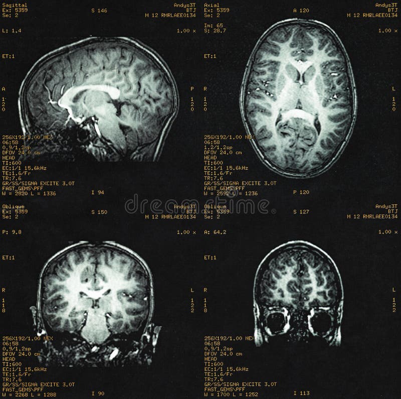 MRI of a child s brain stock photo. Image of skull, human - 9696156