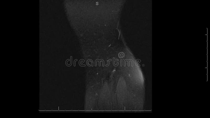 MRI of Knee without Contrast Stock Video - Video of contrasting ...
