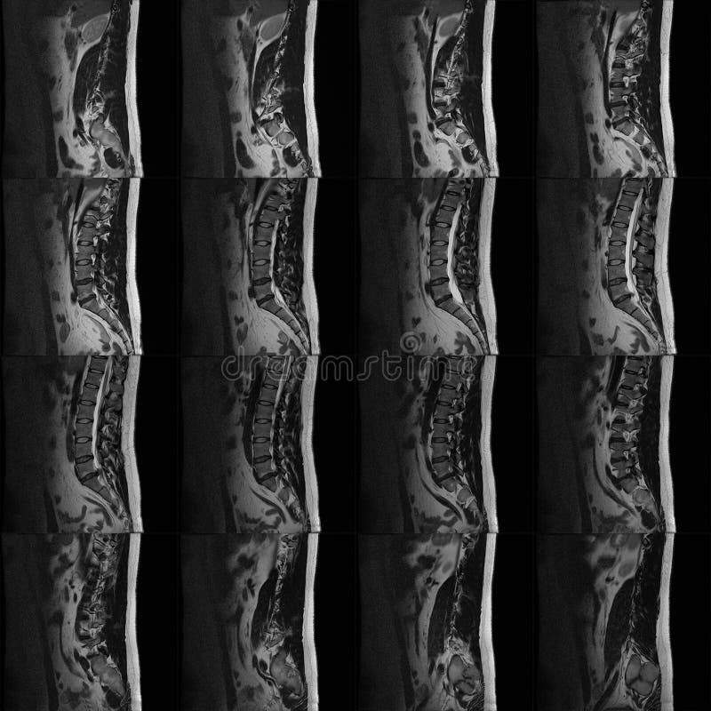 MRI Da Coluna Vertebral Lombar E Torácica Imagem de Stock - Imagem de ...