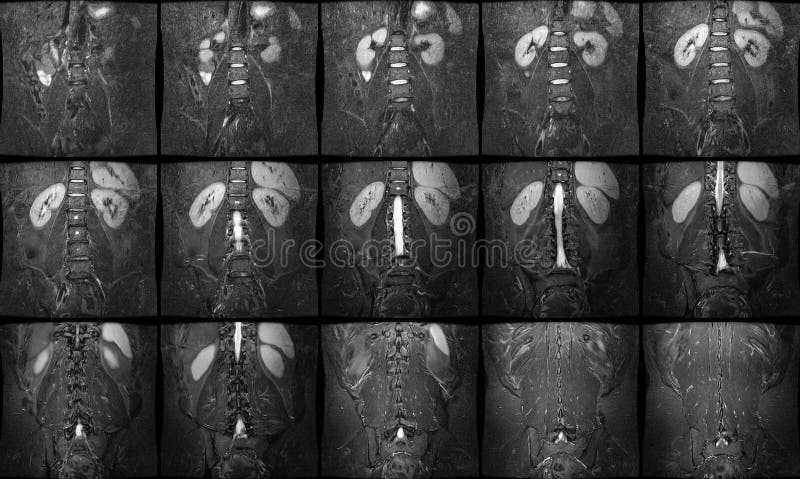 MRI De órgãos Do Abdômen E Da Coluna Vertebral Imagem de Stock - Imagem ...
