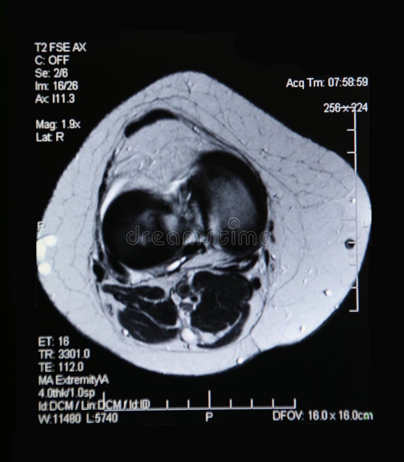 Mri Severo Del Synovitis De La Artritis Reumatoide De La Rodilla Foto ...