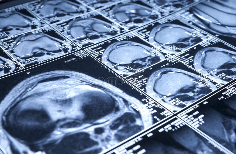 MRI De La Rodilla - Visión Superior Imagen de archivo - Imagen de salud ...