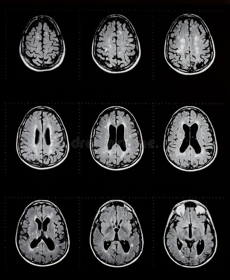 Mri Del Cervello Che Mostra Sclerosi A Placche Immagine Stock ...