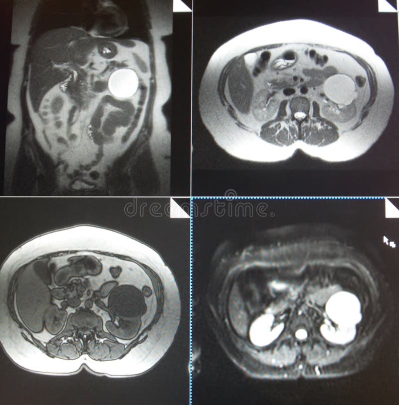 Mri do quisto renal foto de stock. Imagem de base, liga - 52528174