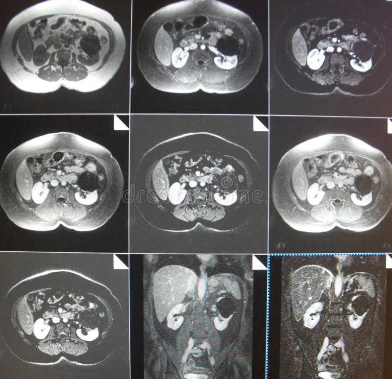 Mri do quisto renal foto de stock. Imagem de base, liga - 52528174