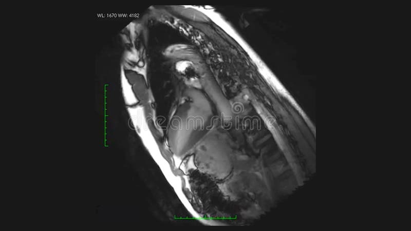 MRI Heart or Cardiac MRI of Heart in Coronal View Stock Video - Video ...