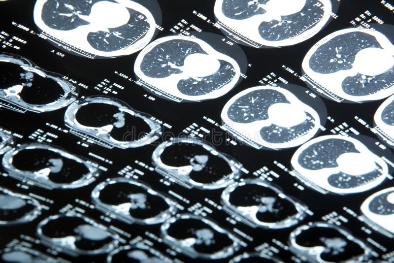 MRI of human brain stock image. Image of radiology, power - 23977177