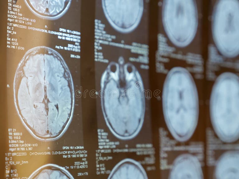 MRI Human Brain with Multiple Sclerosis Stock Image - Image of ...