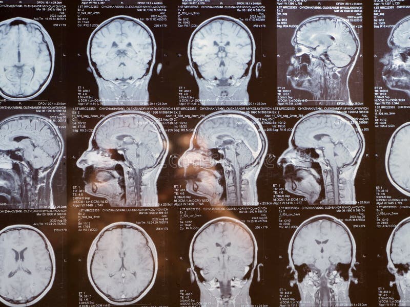 MRI Human Brain with Multiple Sclerosis Stock Image - Image of medical ...