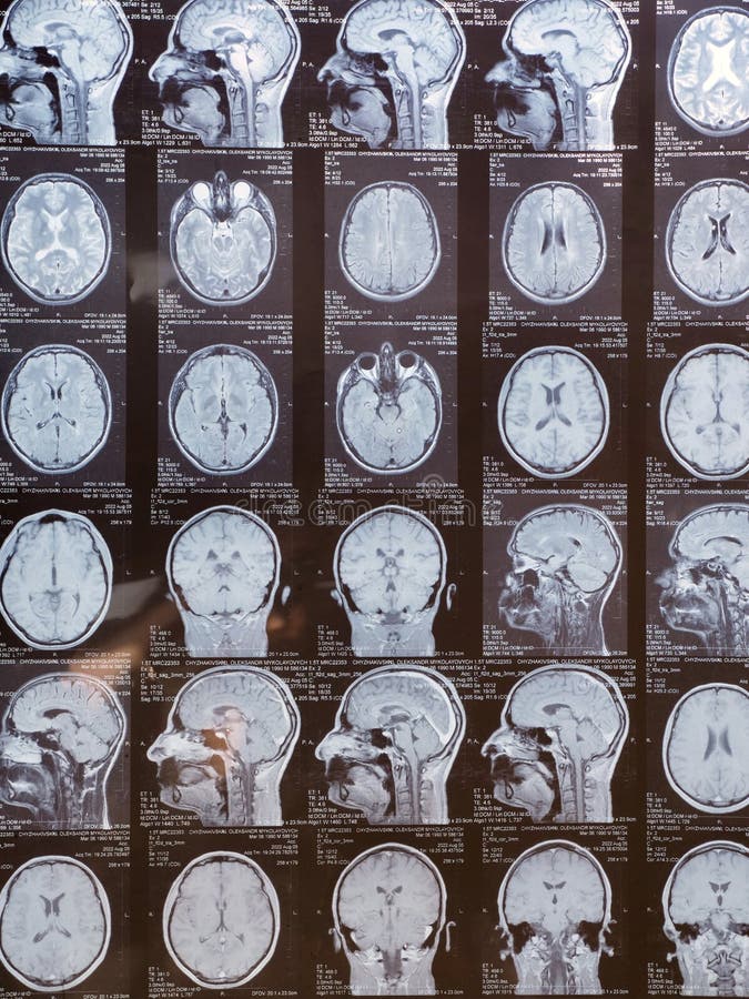 MRI Human Brain with Multiple Sclerosis Stock Image - Image of ...