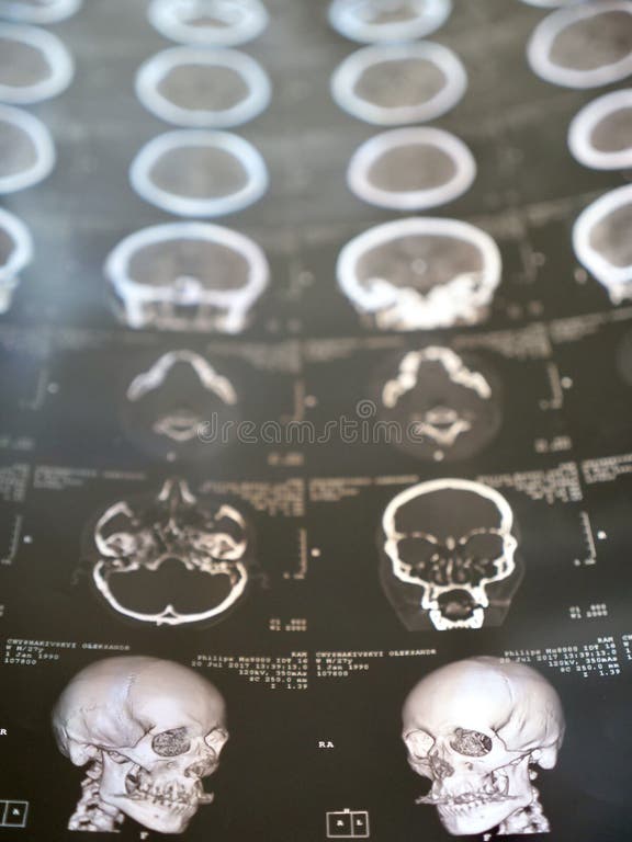 MRI Human Brain with Multiple Sclerosis Stock Image - Image of ...