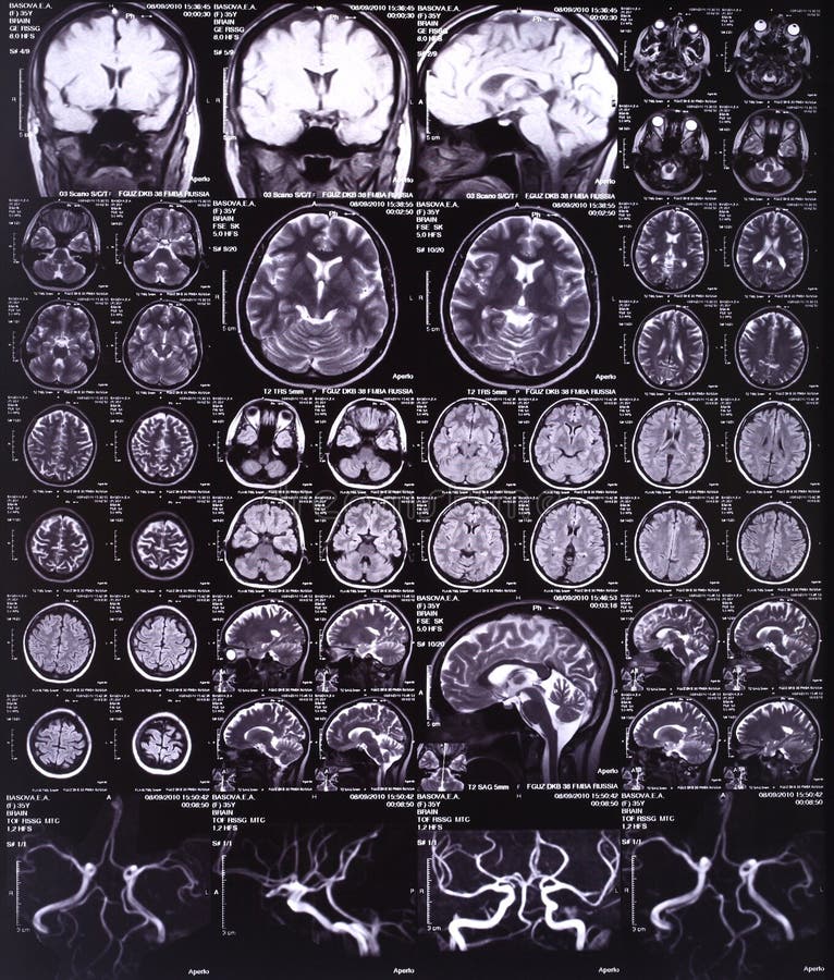 MRI of the brain stock image. Image of medical, resonance - 16741901