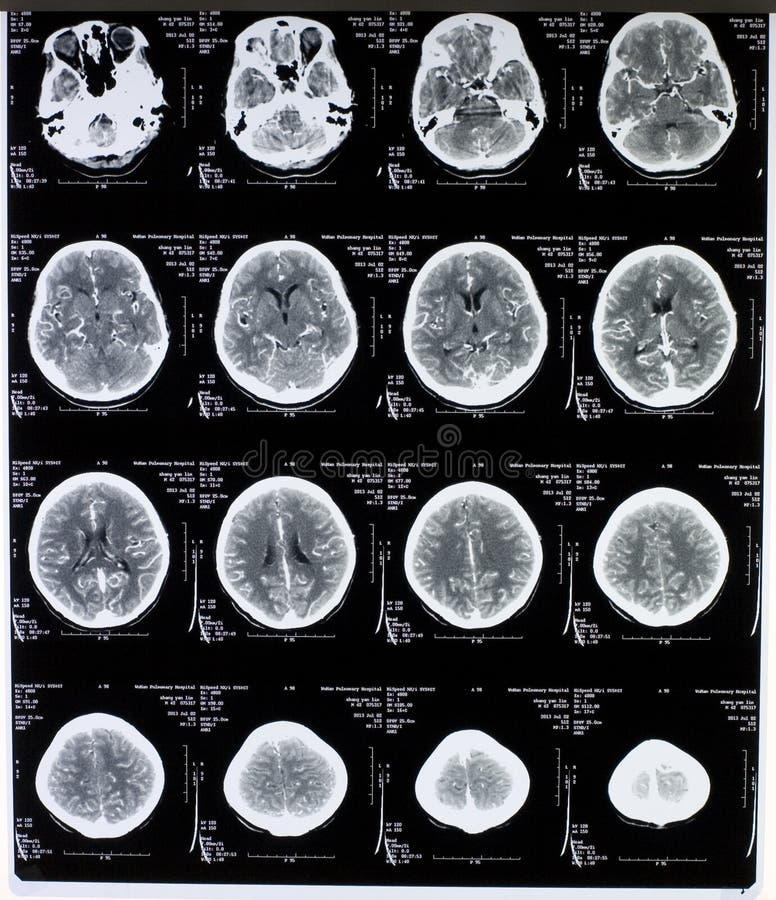 MRI C-spine stock image. Image of industry, health, intervertebral ...