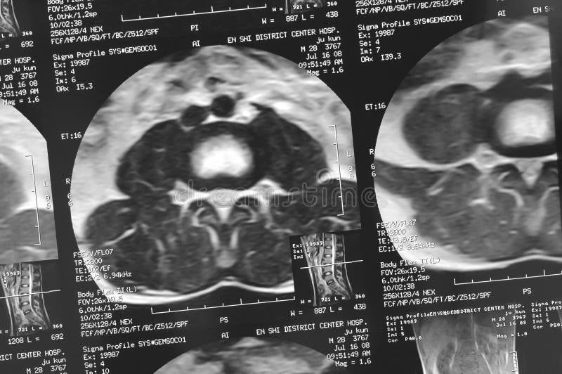 MRI image stock photo. Image of spine, column, shadowgraph - 34601322
