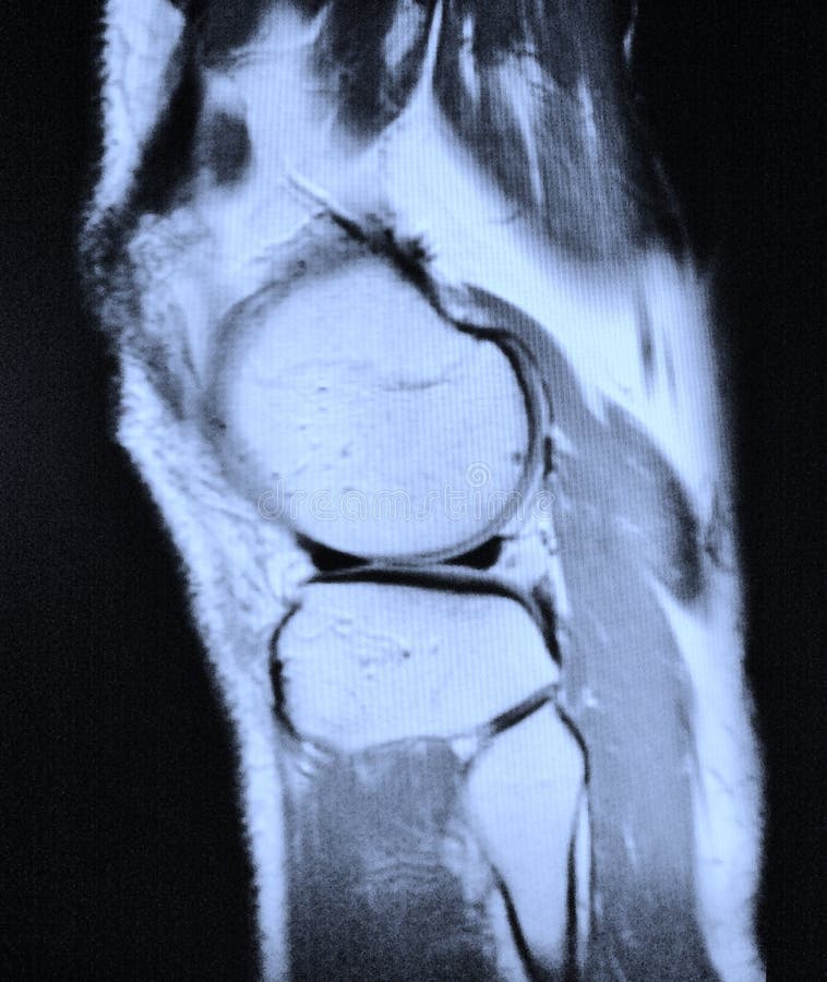 Mri Izquierdo De La Rodilla Foto de archivo - Imagen de tejidos ...