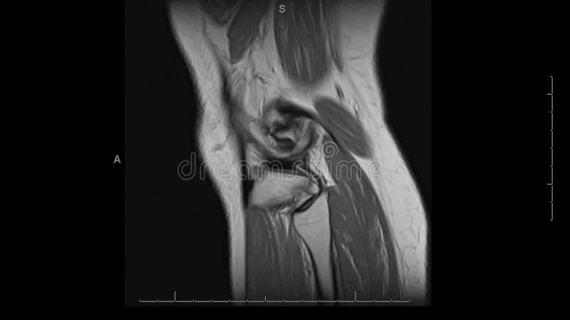 CT Scan Knee of the Patient Periarticular Injuries Fracture of the ...
