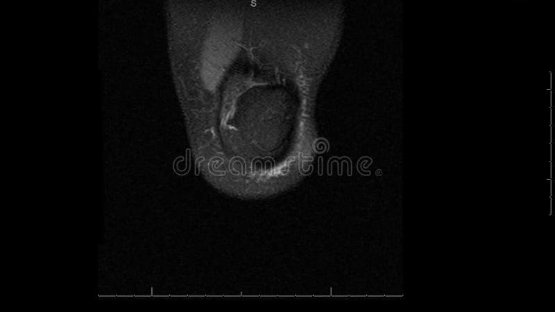 MRI of Knee without Contrast Stock Video - Video of contrasting ...